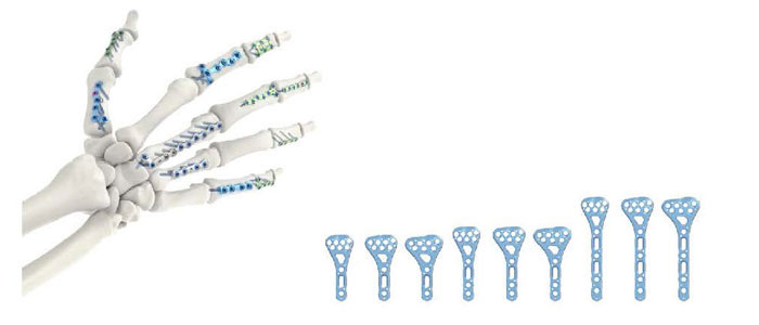 Bone Fixation Plate System and Variable Locking Screw – Korean ...