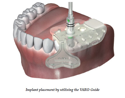 Digital Implant Guide ‘VARO Guide’ – Korean-Electronics.com