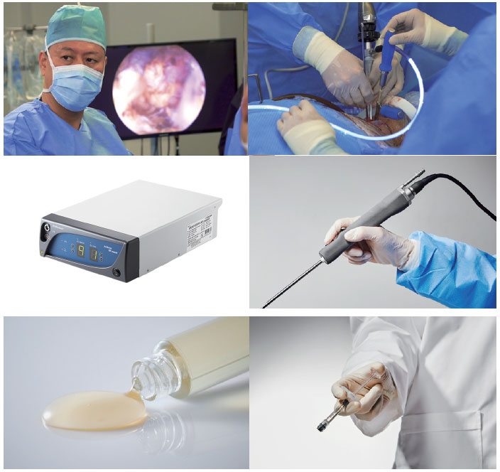 Unilateral Biportal Endoscopy(UBE) Technique for Minimal Invasive ...